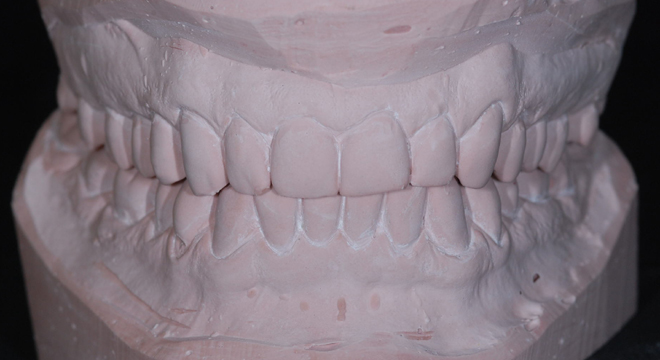 Modelli dentali – Dentiblog.net